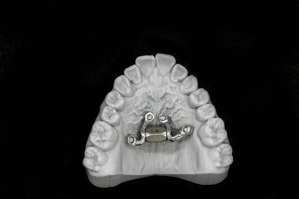 MJ Dentlab | TAD Appliances in dental appliances - MJ Dentlab in Sydney